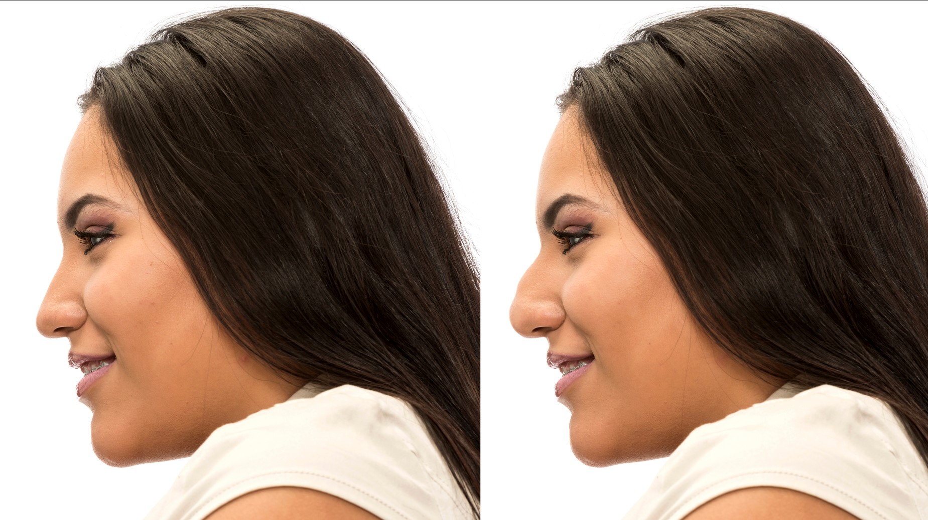 flipped nose - Wiesman Nasal & Sinus Blog