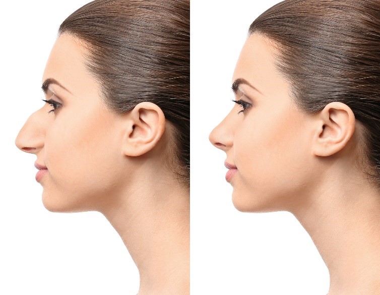 Transform Your Appearance with Rhinoplasty in Chicago Today!